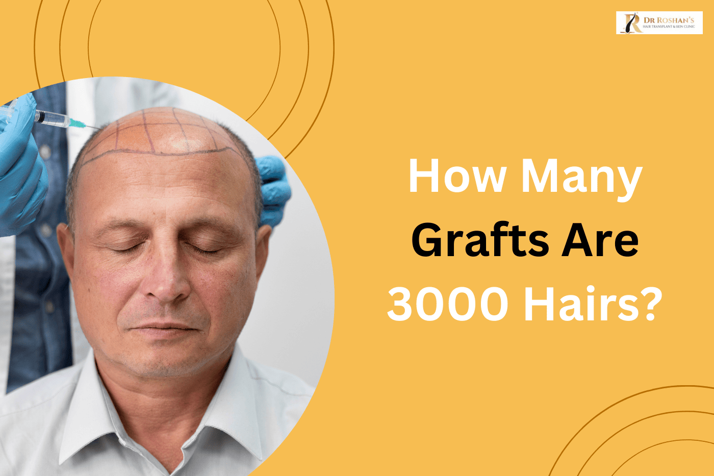 How many grafts are 3000 hairs? best hair transplant in Bangalore